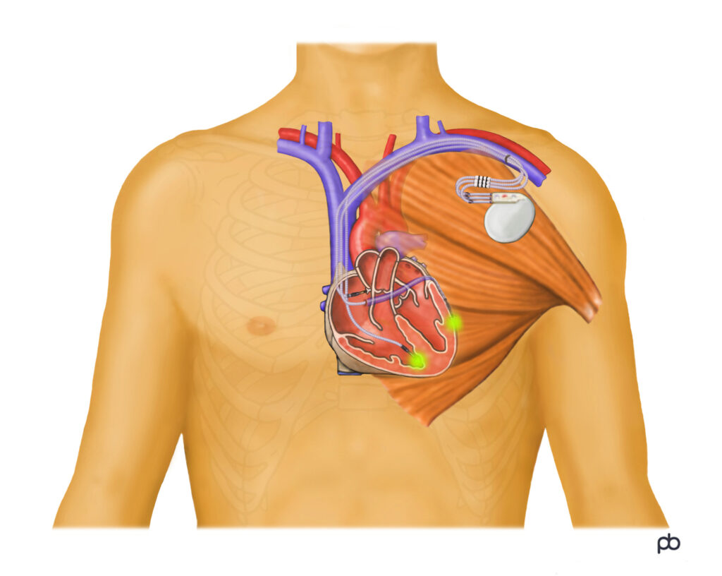 Pacemaker ICD Lead Extraction - Leeds Teaching Hospitals NHS Trust