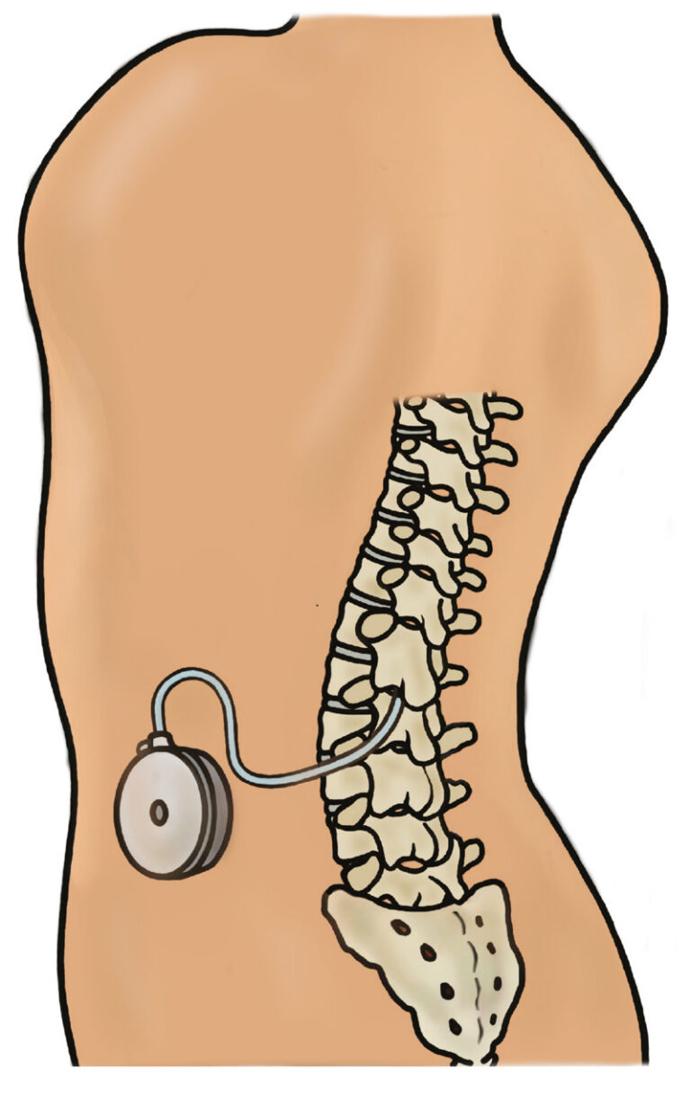 Intrathecal Baclofen - Leeds Teaching Hospitals NHS Trust