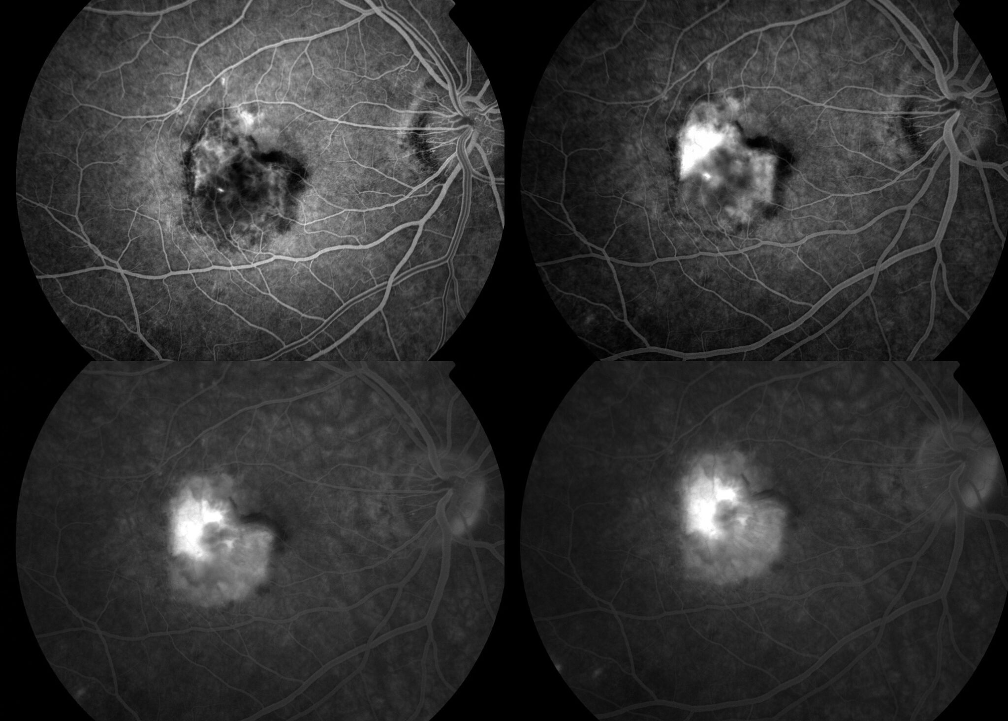 What is Fundus Fluorescein Angiography and Indocyanine Green ...