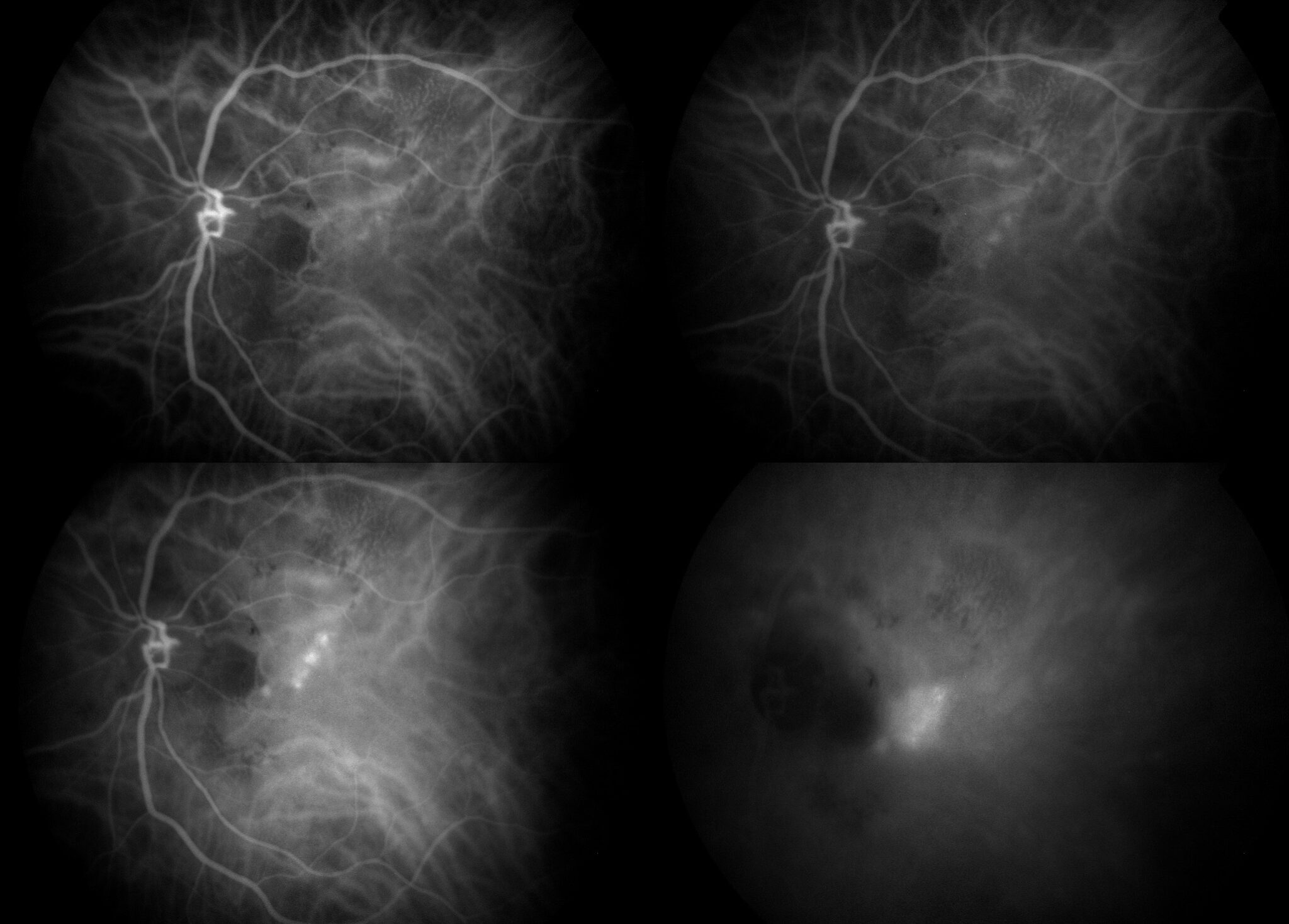 What is Fundus Fluorescein Angiography and Indocyanine Green ...