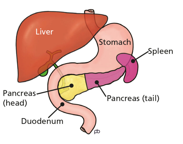 Distal Pancreatectomy An operation to remove part of your pancreas ...