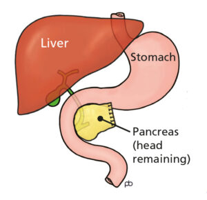 Distal Pancreatectomy An operation to remove part of your pancreas ...