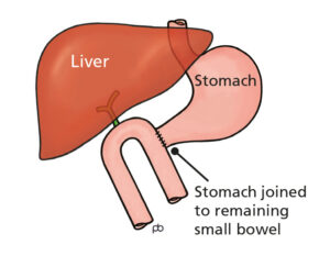 Total Pancreatectomy - Leeds Teaching Hospitals NHS Trust