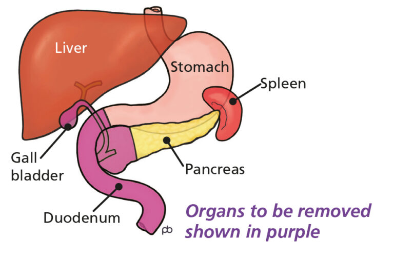 Whipples Operation (Pylorus preserving pancreatico-duodenectomy ...