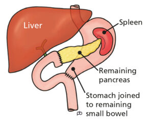 Whipples Operation (Pylorus preserving pancreatico-duodenectomy ...