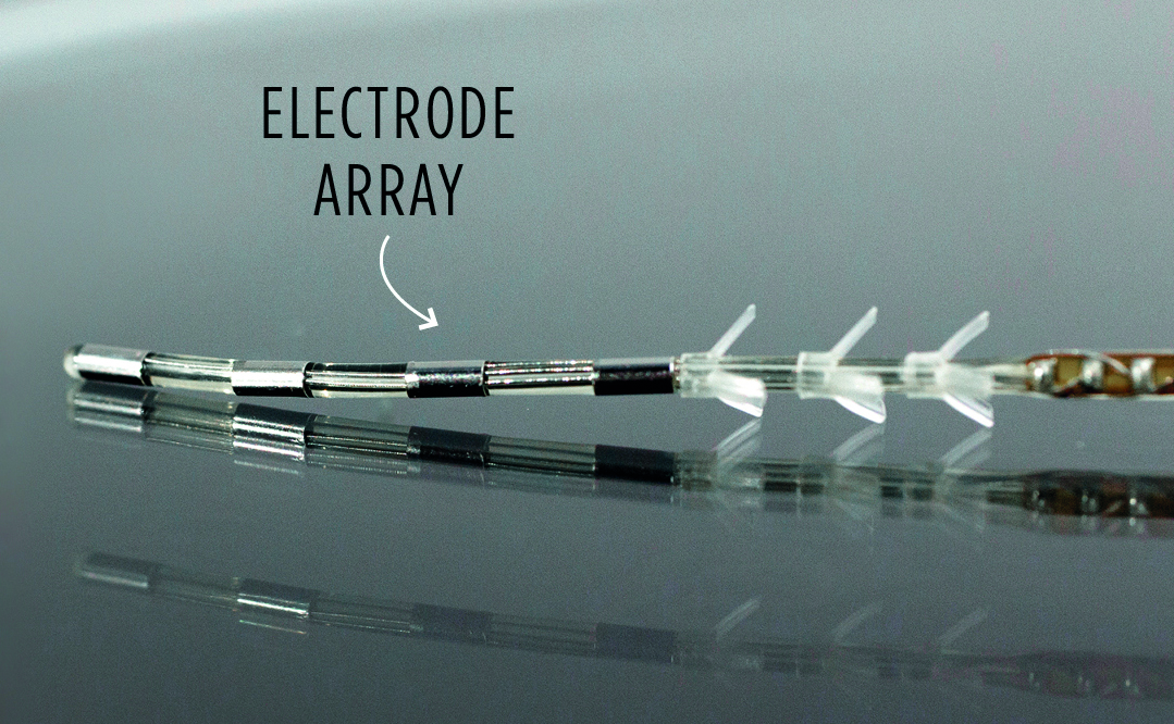 Peripheral Nerve Stimulation (PNS) - Leeds Teaching Hospitals NHS Trust