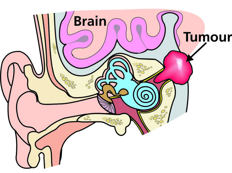 Acoustic Neuroma - Leeds Teaching Hospitals NHS Trust
