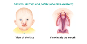 Cleft Lip and Palate - Leeds Teaching Hospitals NHS Trust