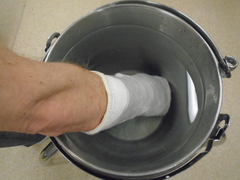 Removal of a Plaster of Paris (POP) cast - Leeds Teaching Hospitals NHS ...