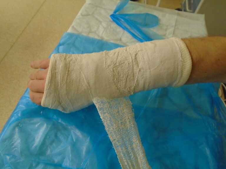 Removal of a Plaster of Paris (POP) cast - Leeds Teaching Hospitals NHS ...