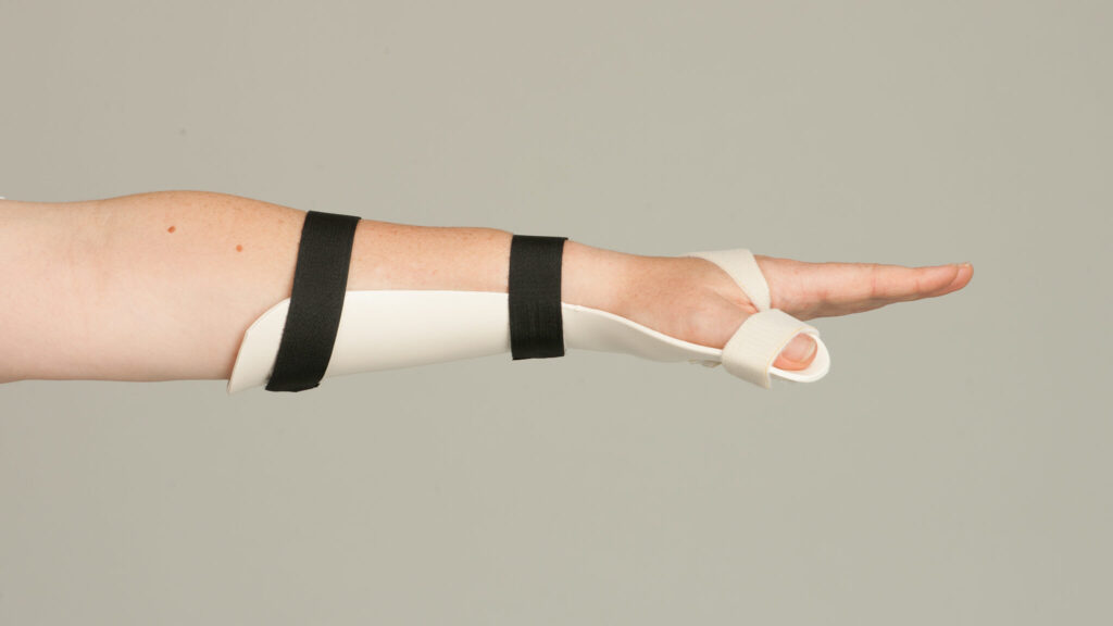 Extensor Tendon Repair (thumb), a guide to your therapy - Leeds ...