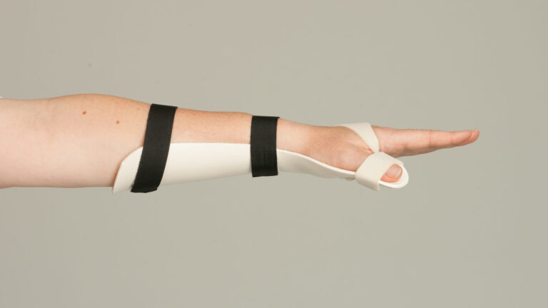 Extensor Tendon Repair (thumb), a guide to your therapy - Leeds ...