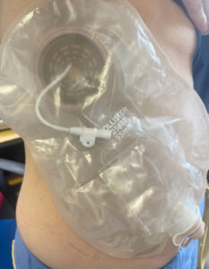 Nephrostomy Passport - Leeds Teaching Hospitals NHS Trust