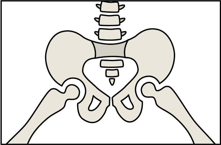 Developmental Dysplasia of the Hip - Leeds Teaching Hospitals NHS Trust