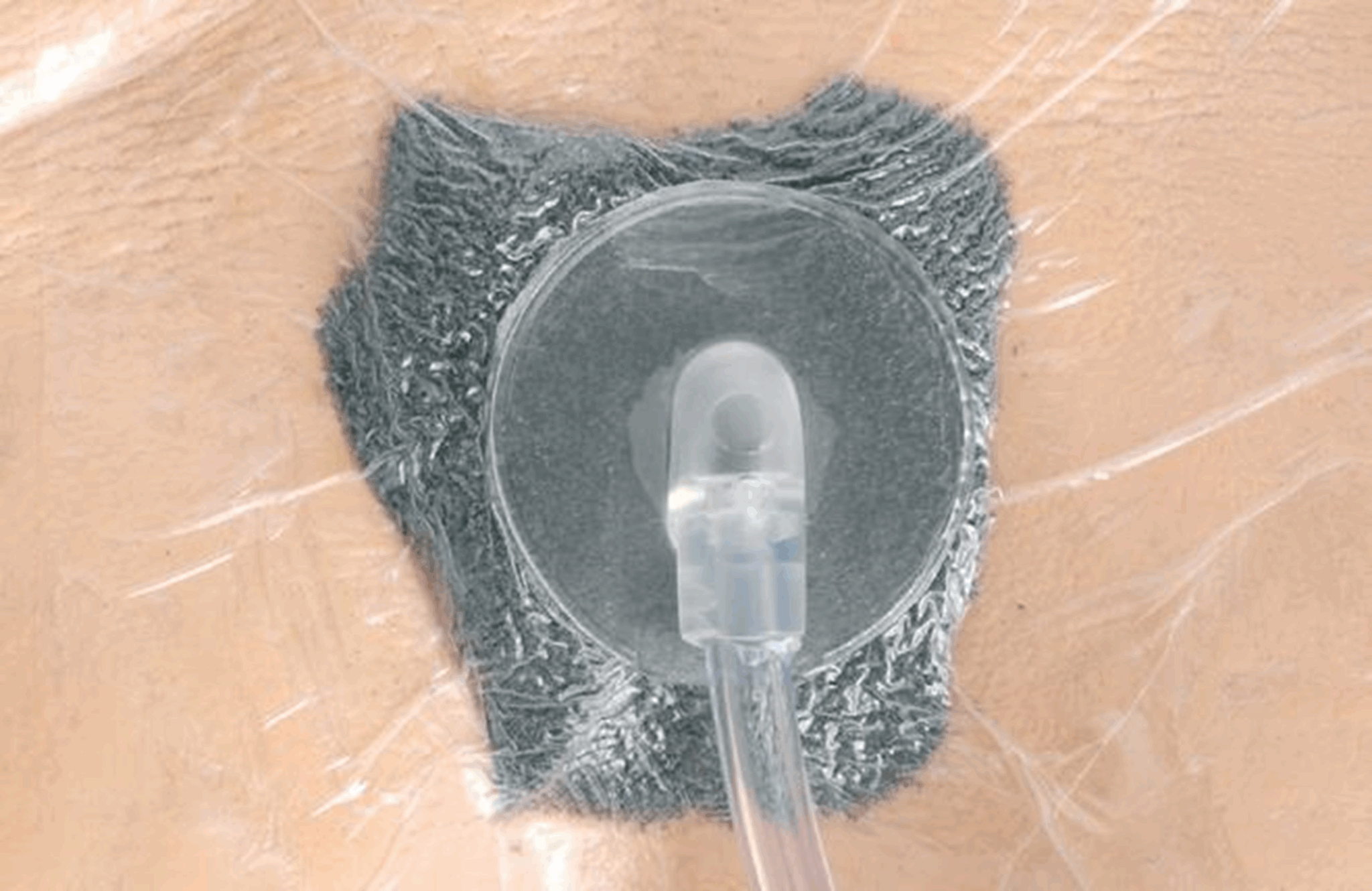 Negative Pressure Wound Therapy (NPWT) - Leeds Teaching Hospitals NHS Trust