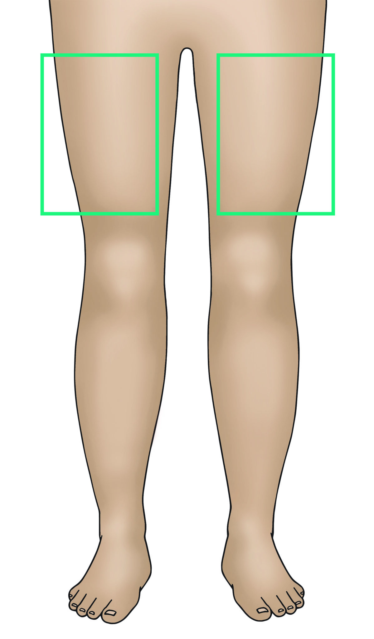 Emergency Hydrocortisone Injection - Leeds Teaching Hospitals NHS Trust