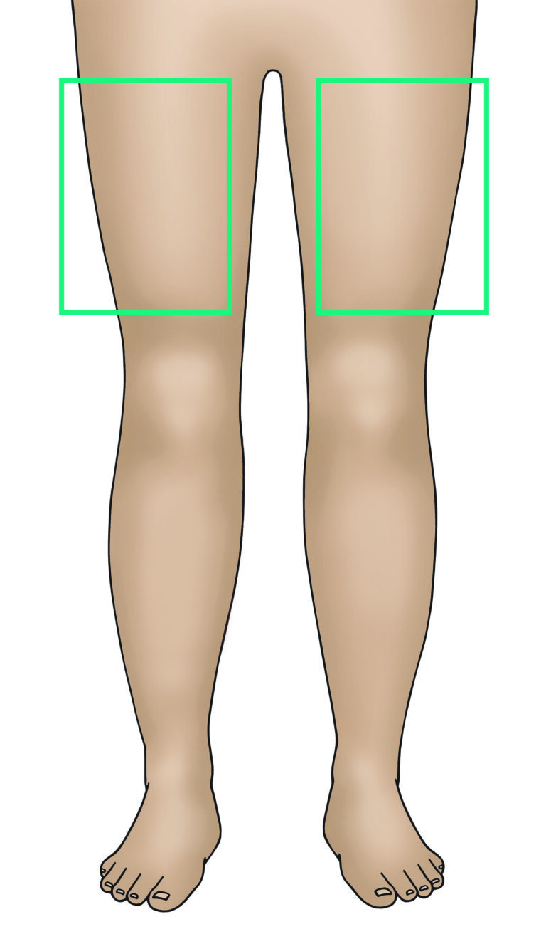 Emergency Hydrocortisone Injection - Leeds Teaching Hospitals NHS Trust