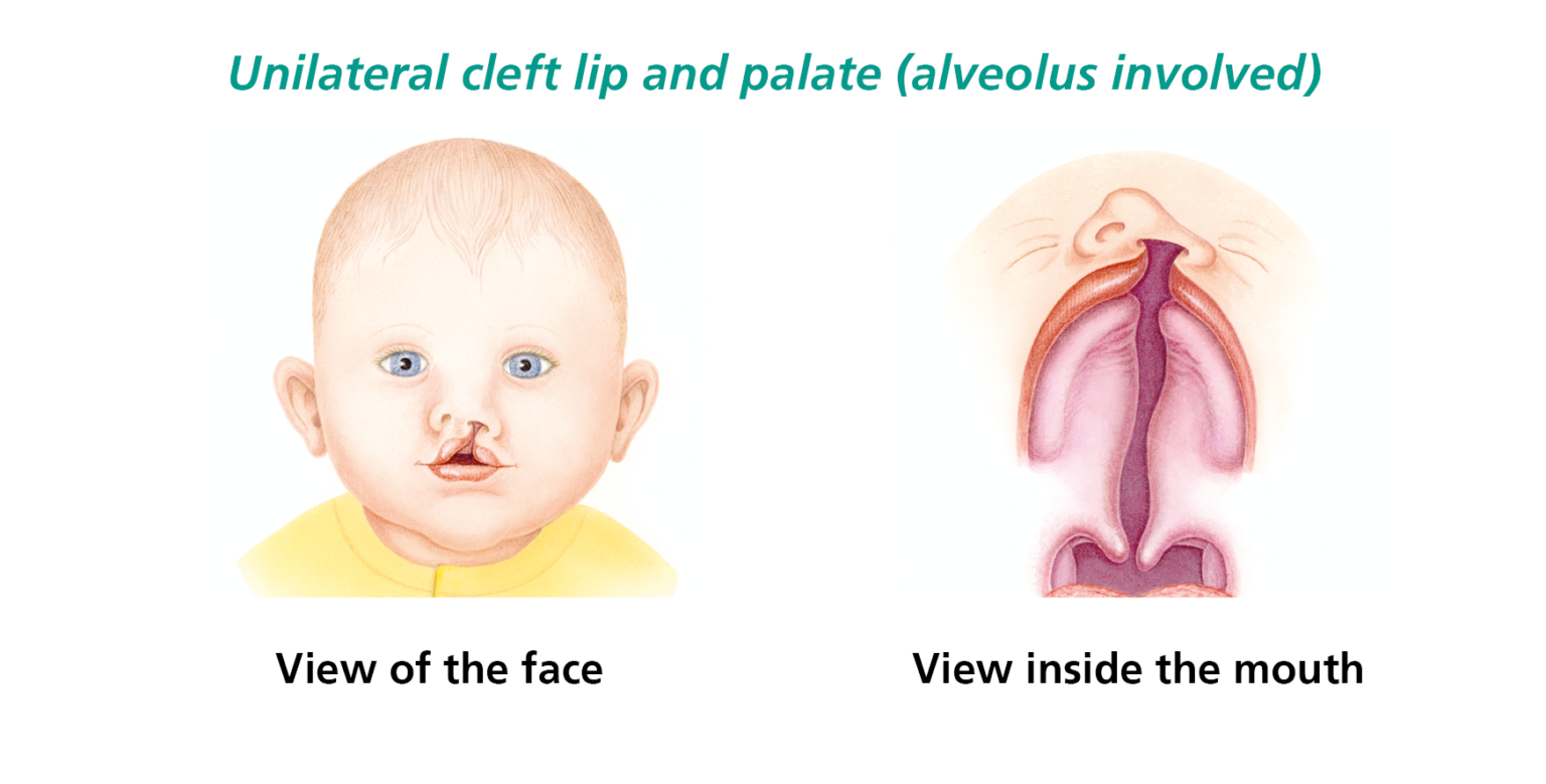 Cleft Lip and Palate - Leeds Teaching Hospitals NHS Trust