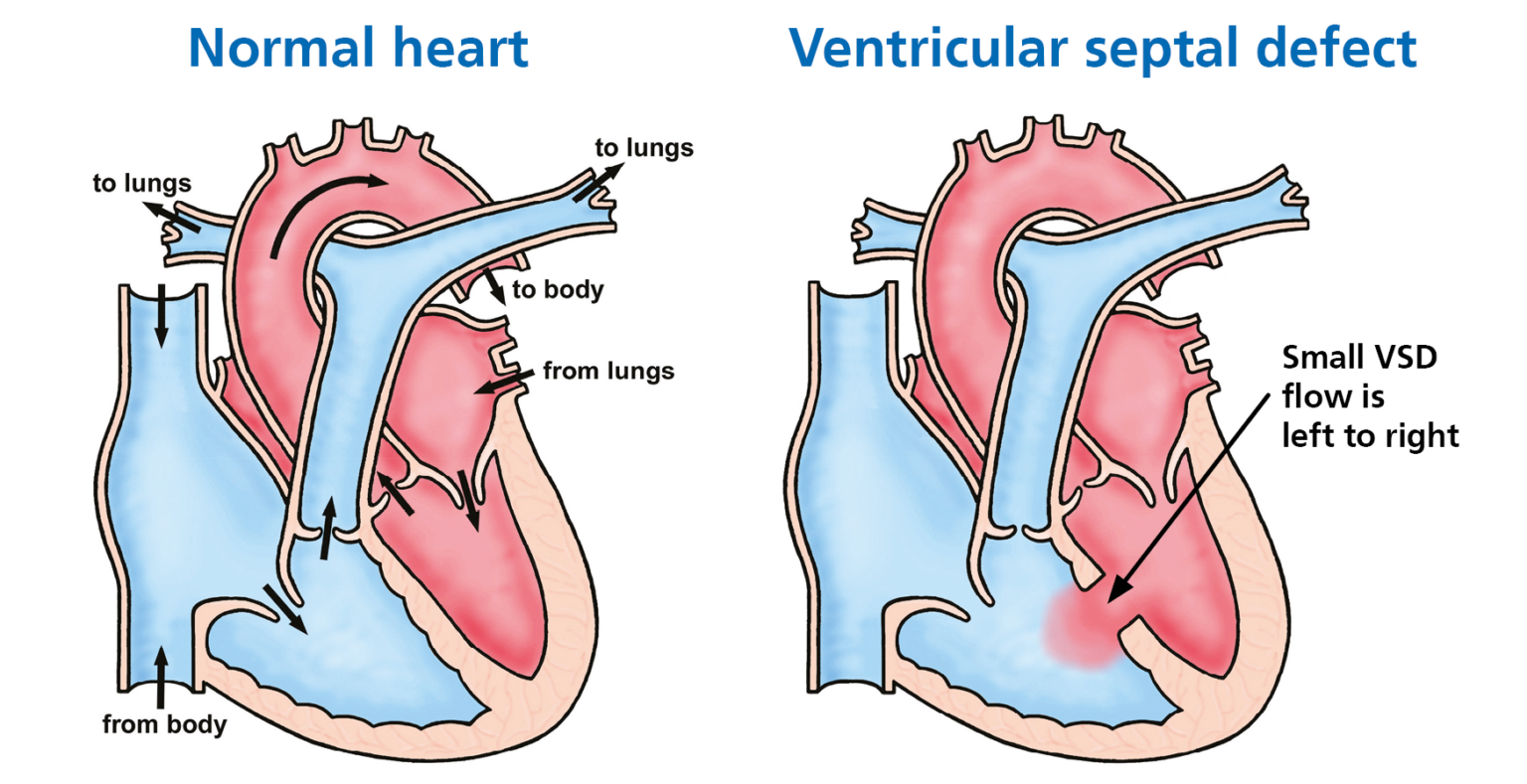 Ventricular Septal Defect - Leeds Teaching Hospitals NHS Trust