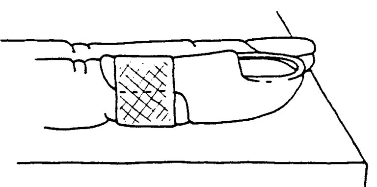 Mallet Splint Instructions - Leeds Teaching Hospitals NHS Trust