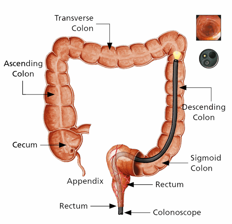 Having a Colonoscopy - A guide to the test - Leeds Teaching Hospitals ...