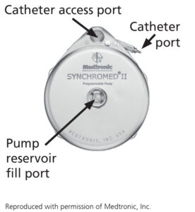 Intrathecal pumps for pain management - Leeds Teaching Hospitals NHS Trust