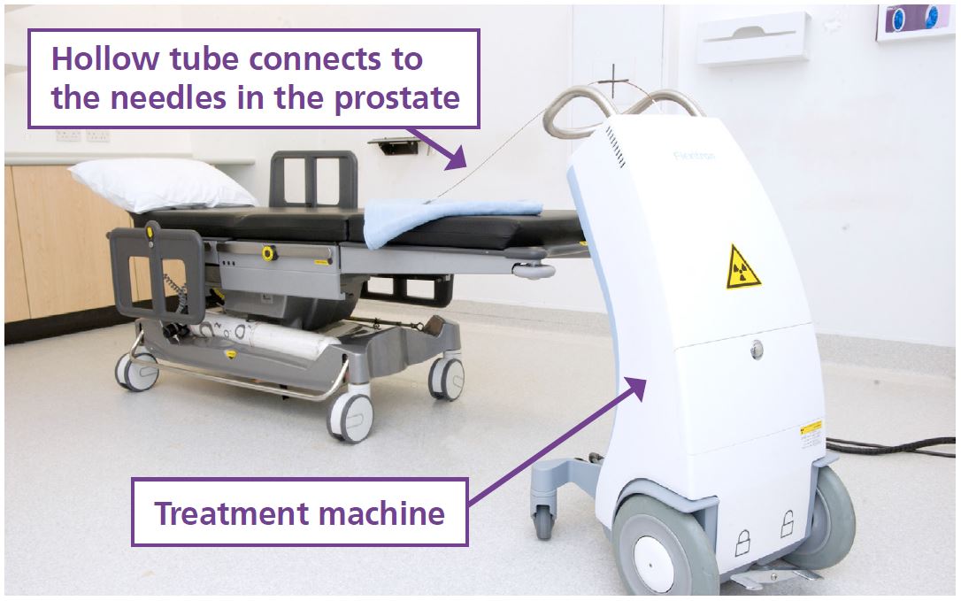 Prostate Brachytherapy using High Dose Rate (HDR) Temporary ...