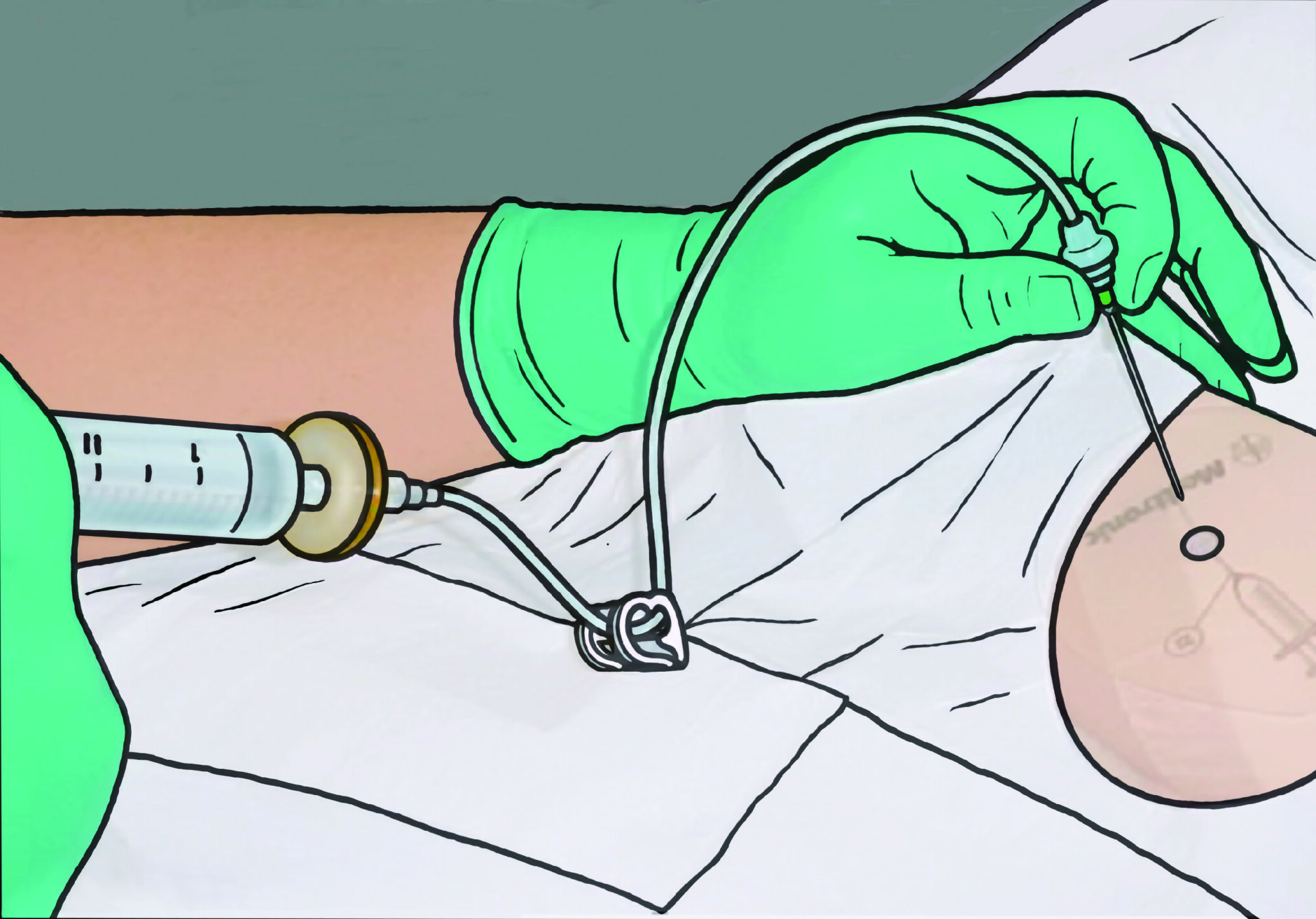 Intrathecal pumps for pain management - Leeds Teaching Hospitals NHS Trust