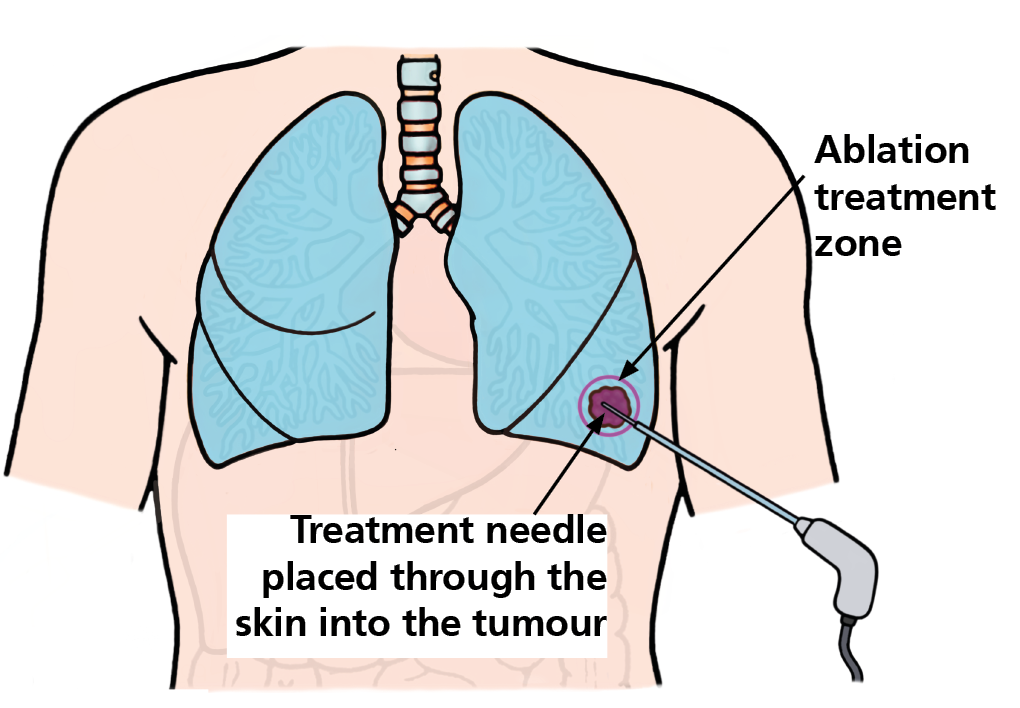 Image guided ablation of lung tumours - Leeds Teaching Hospitals NHS Trust