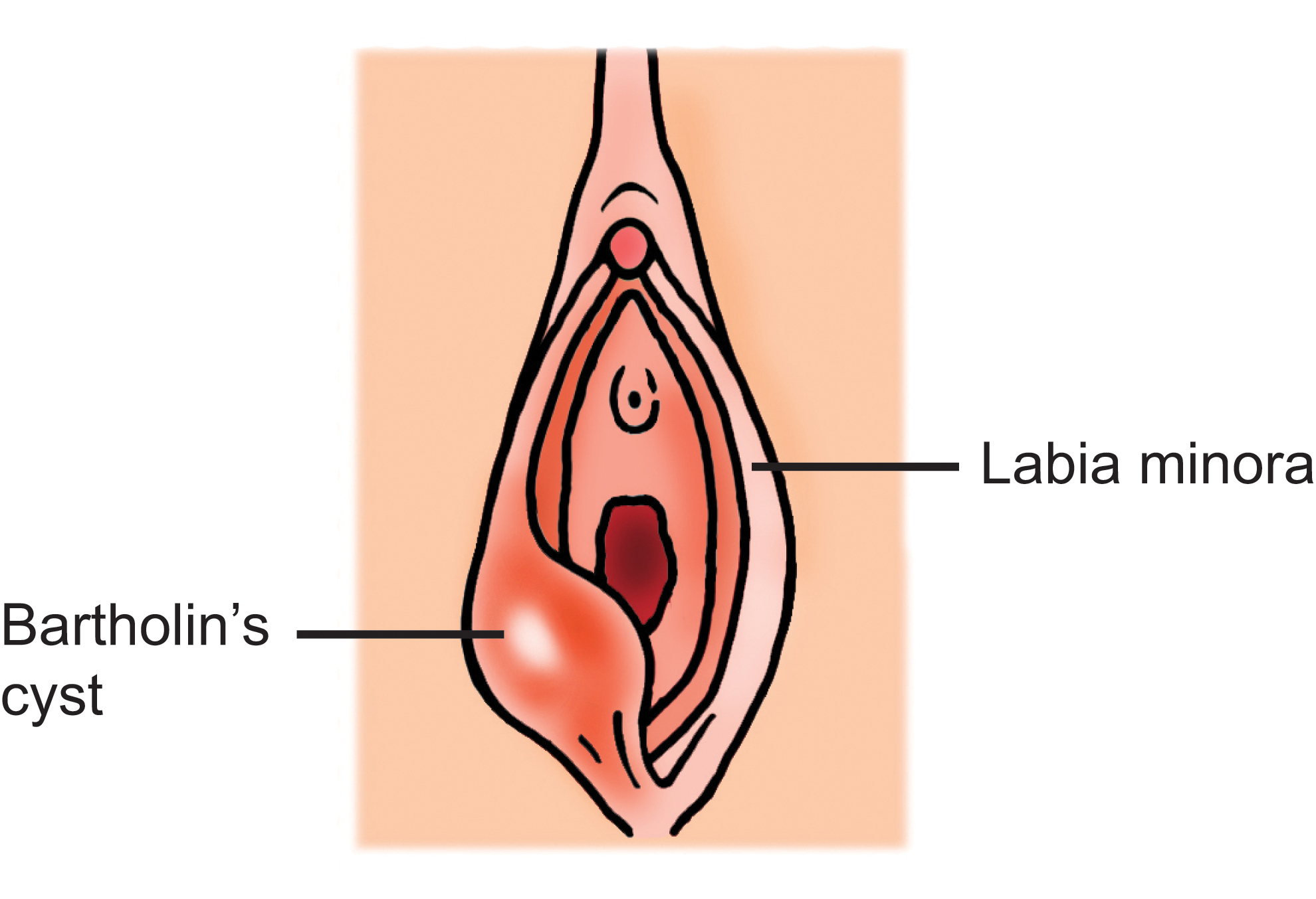 Bartholin’s cyst and abscess - Leeds Teaching Hospitals NHS Trust