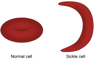 Sickle Cell Disease in Children and Young People - Leeds Teaching ...