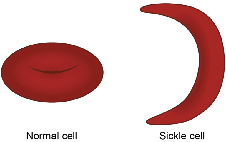 Sickle Cell Disease in Children and Young People - Leeds Teaching ...