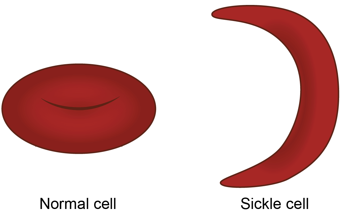 Sickle Cell Disease in Children and Young People - Leeds Teaching ...