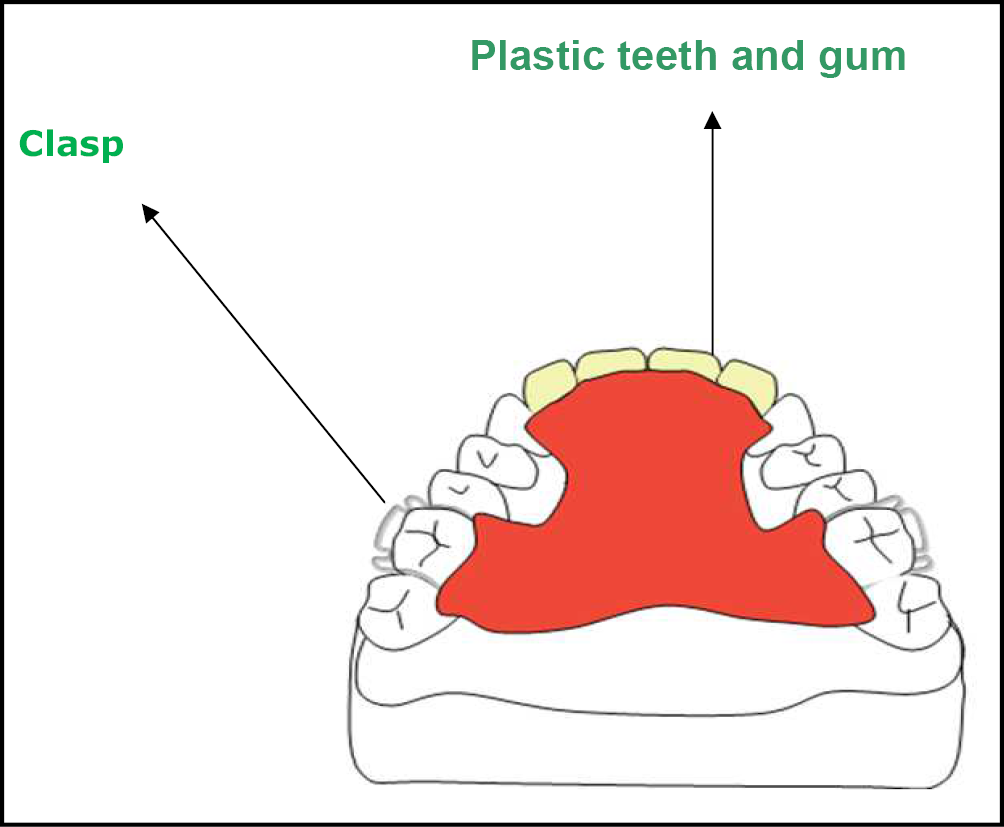 Removable partial dentures - Leeds Teaching Hospitals NHS Trust