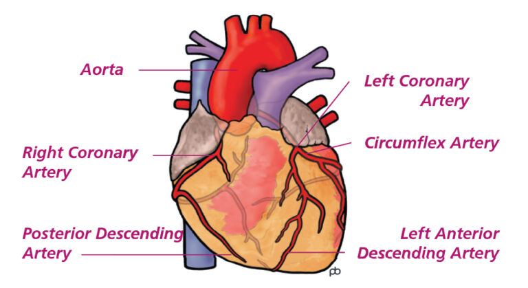 Type 2 Myocardial Infarction (MI) / Heart attack - Leeds Teaching ...