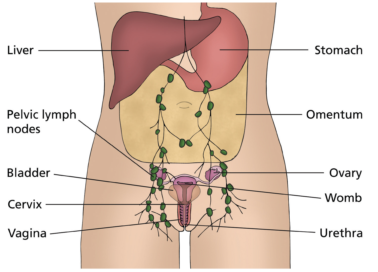 Infected Abdominal Lymph Nodes Cancer That Spreads To Lymph Nodes