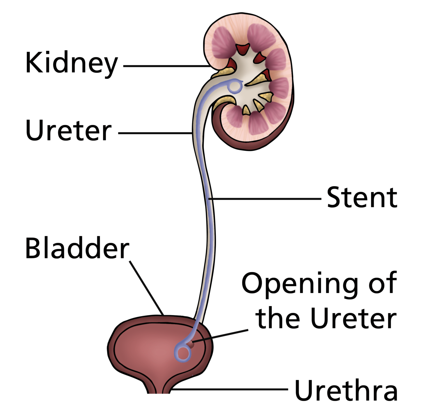 Living with a Ureteric Stent - Leeds Teaching Hospitals NHS Trust