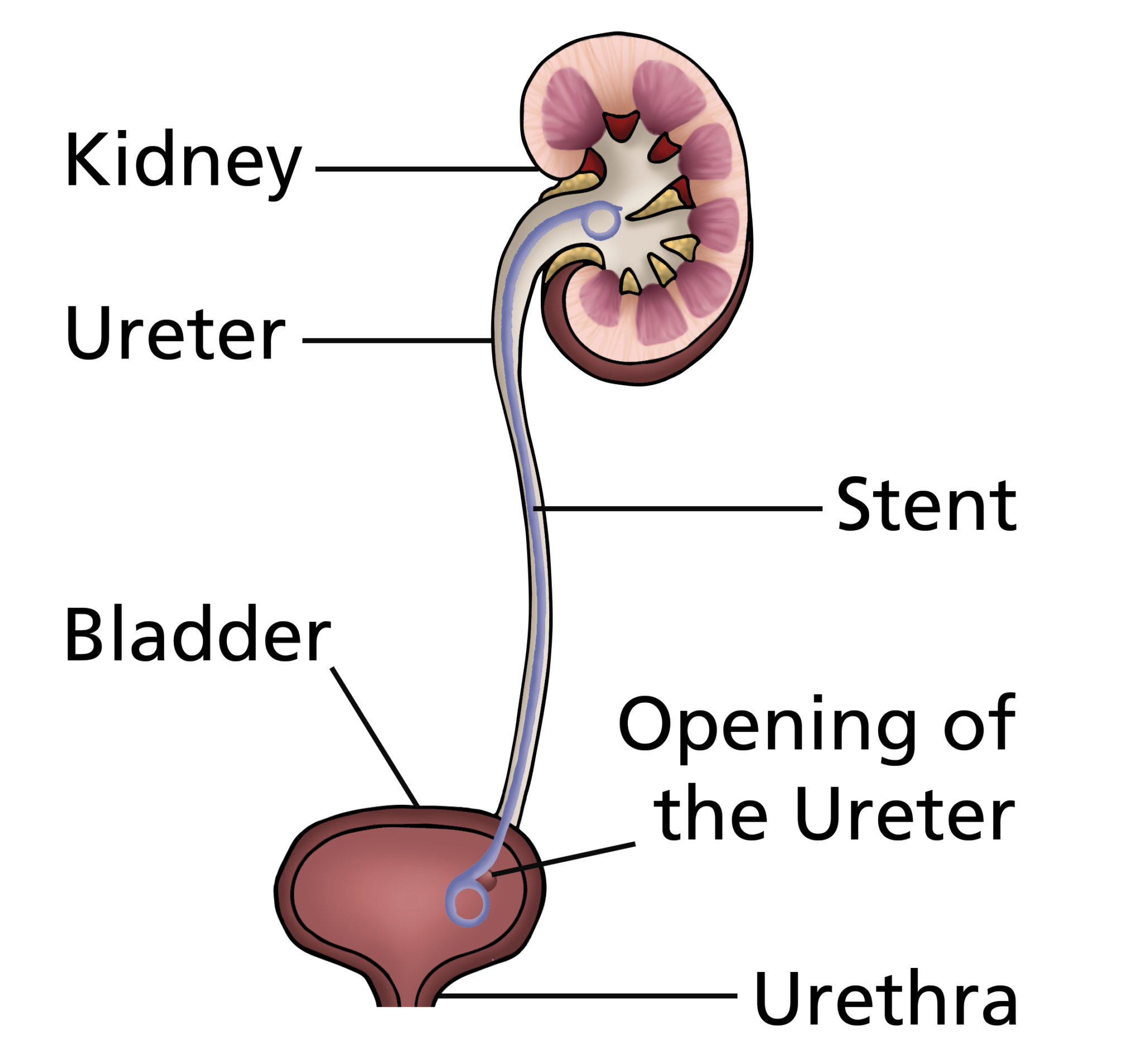 Living with a Ureteric Stent - Leeds Teaching Hospitals NHS Trust