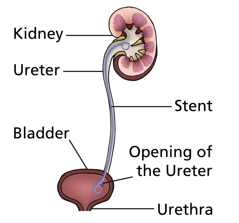Living with a Ureteric Stent - Leeds Teaching Hospitals NHS Trust