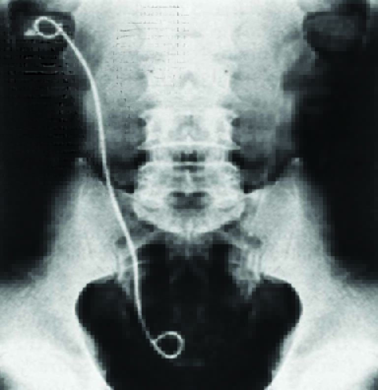 Living with a Ureteric Stent - Leeds Teaching Hospitals NHS Trust