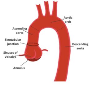 Leeds Aortopathy Clinic and Thoracic Aortic Aneurysms (TAA) - Leeds ...