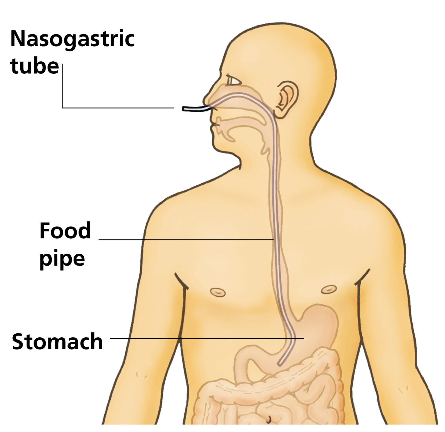 Radiotherapy treatment for Head & Neck cancer - Tube feeding options ...