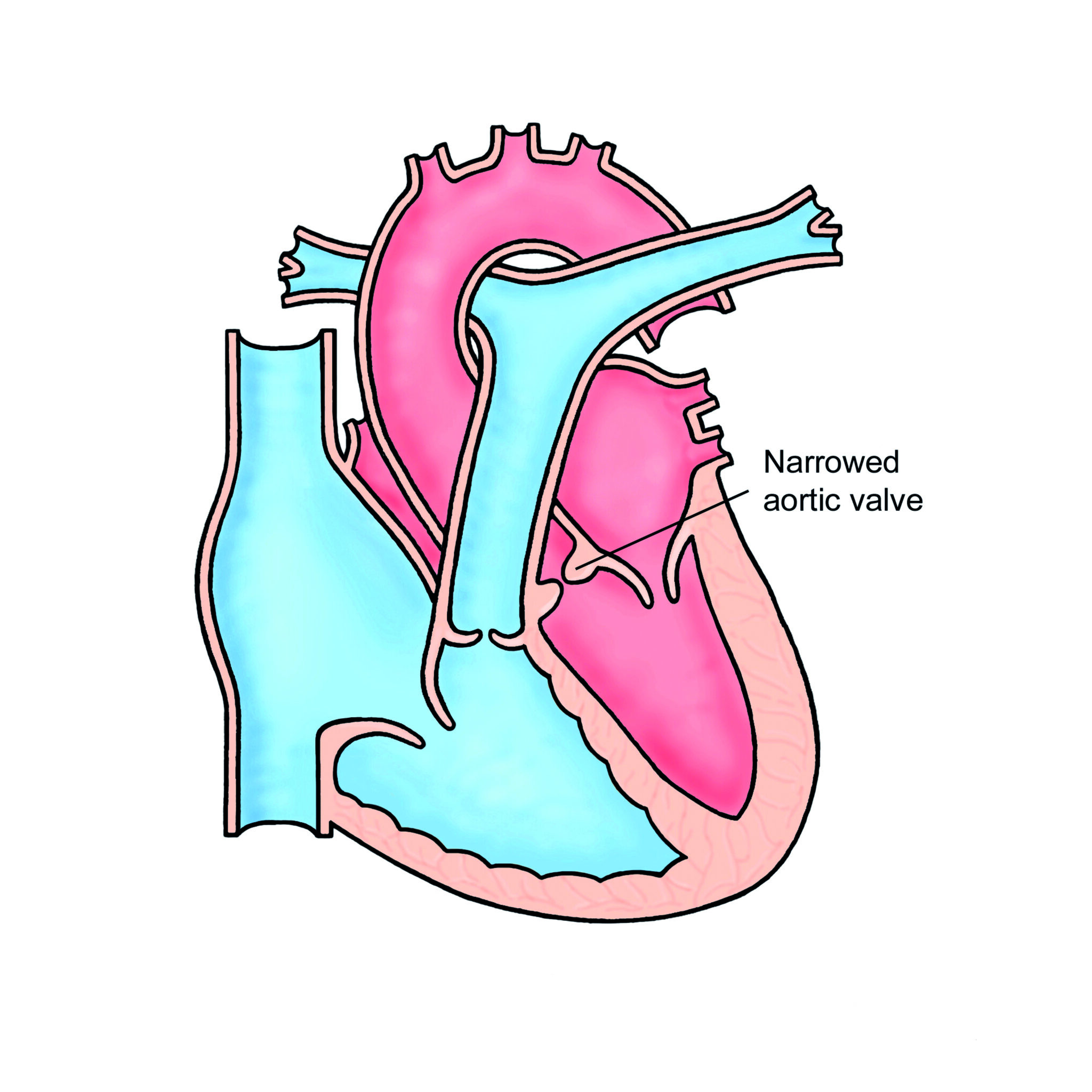 Aortic Valve Disease - Leeds Teaching Hospitals NHS Trust