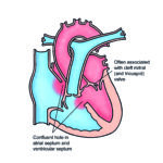 Repaired Atrioventricular Septal Defect (AVSD) - Leeds Teaching ...