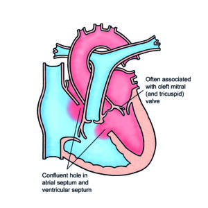 Repaired Atrioventricular Septal Defect (AVSD) - Leeds Teaching ...
