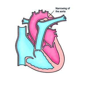 Coarctation of the Aorta - Leeds Teaching Hospitals NHS Trust