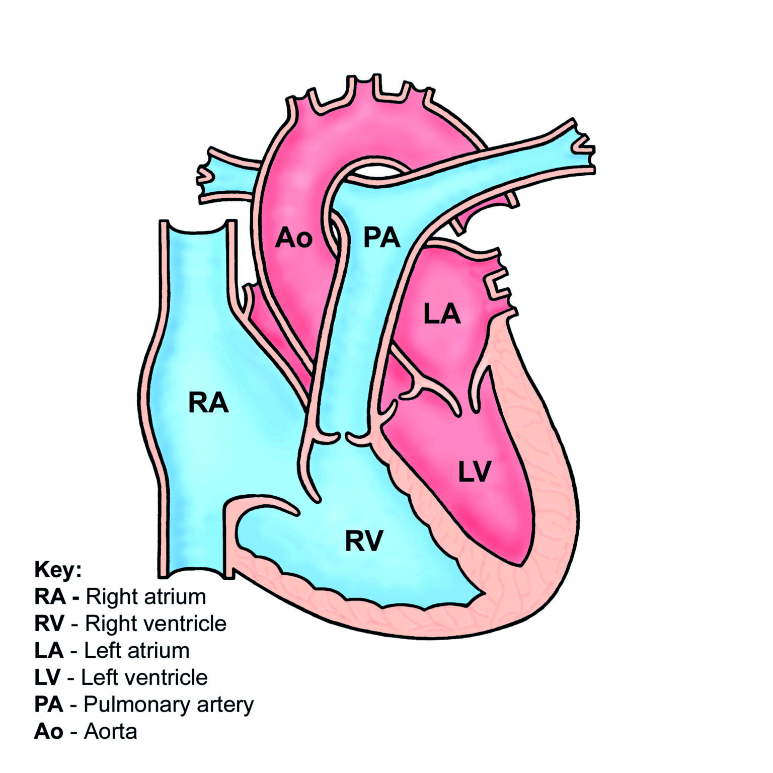 Congenitally Corrected Transposition of the Great Arteries (ccTGA ...