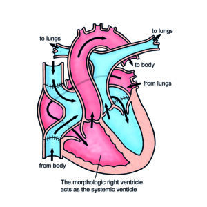 The Atrial Switch (Mustard or Senning) procedure for Transposition of ...