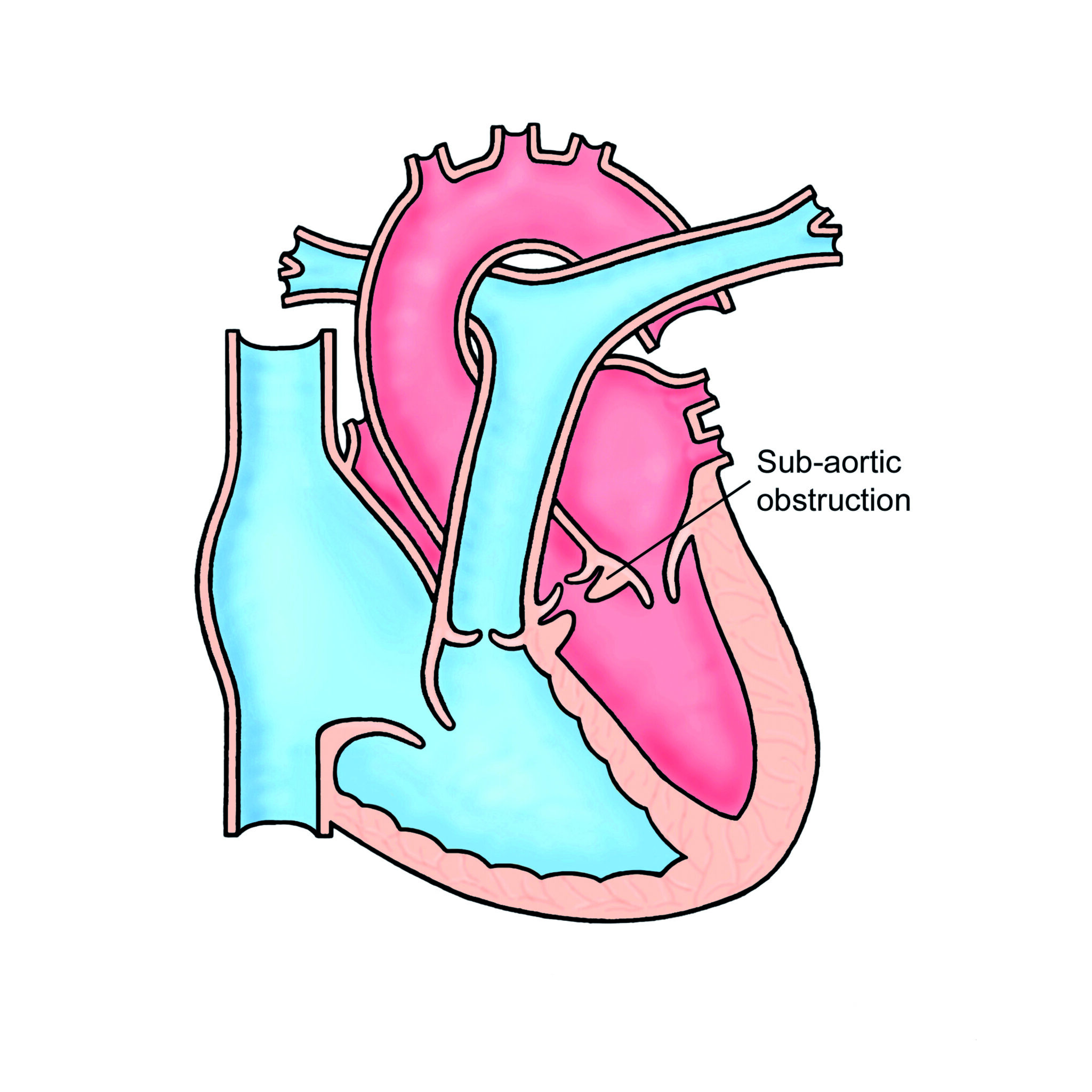 Subaortic Stenosis - Leeds Teaching Hospitals NHS Trust