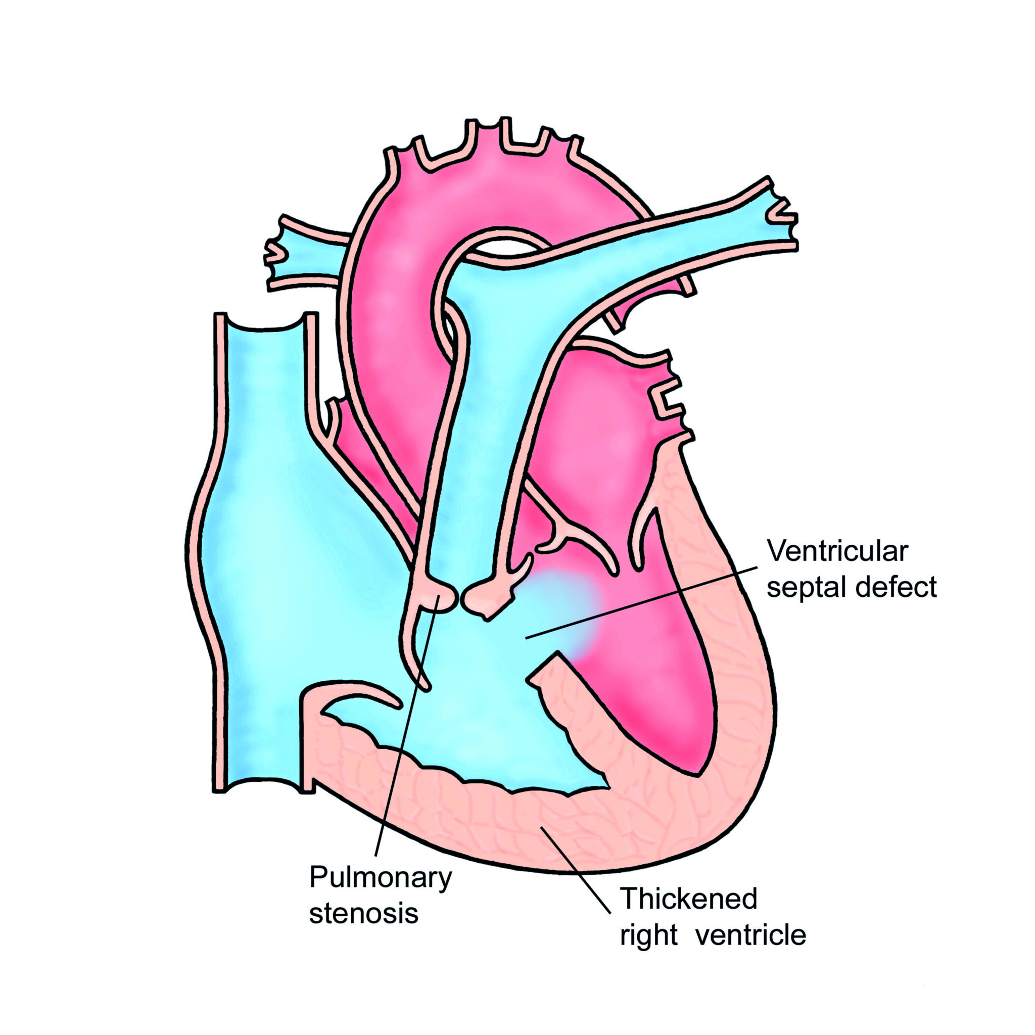 Tetralogy of Fallot - Leeds Teaching Hospitals NHS Trust